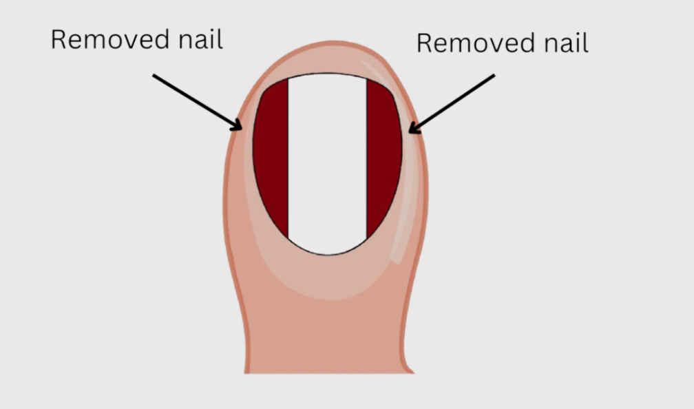 Ingrown Toenails Removal & Infected Toenails Treatment - Nail Surgery ...